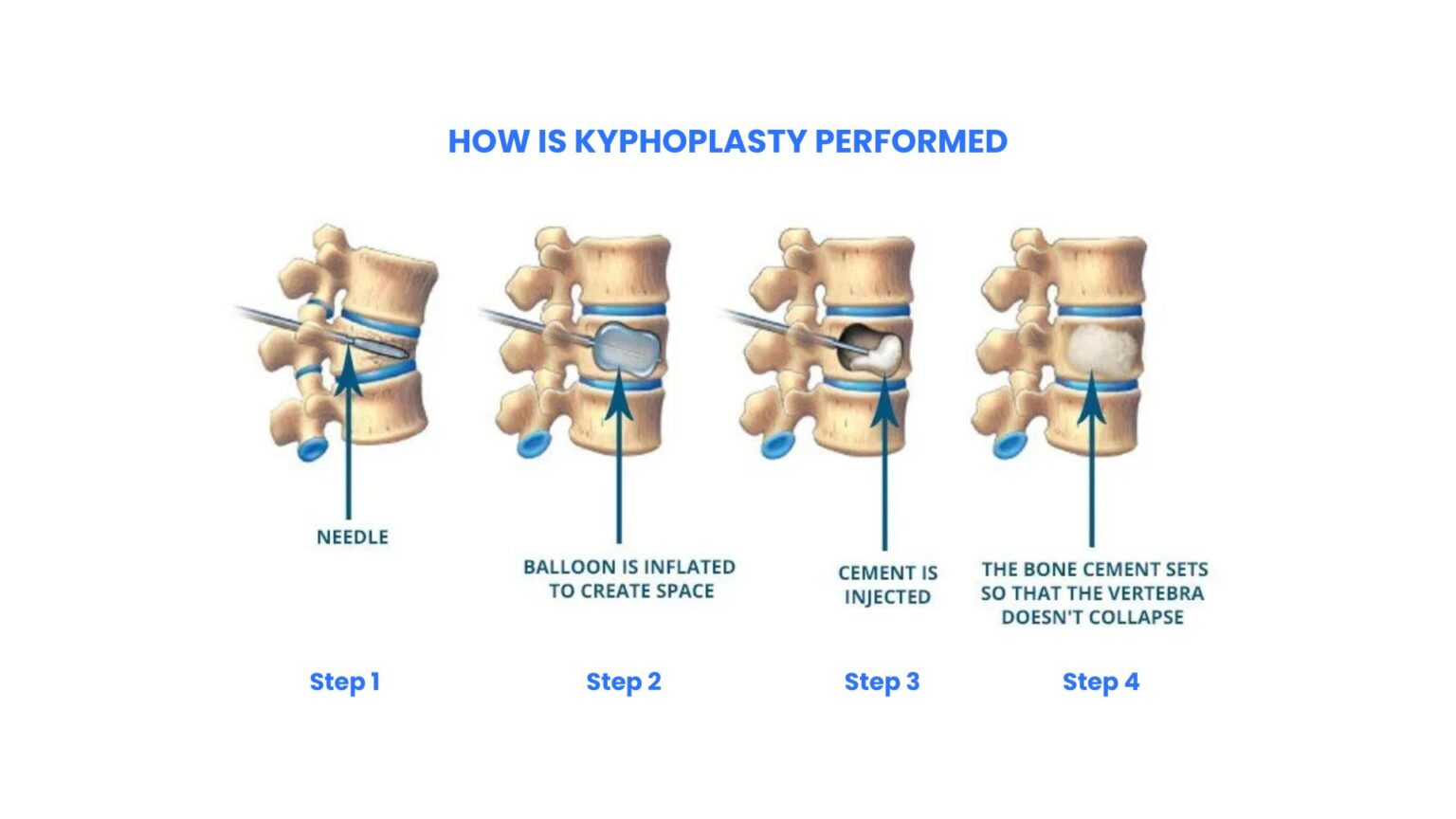 Kyphoplasty Treatment London | Minimally Invasive